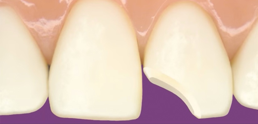 Anterior Composite Restoration Materials Preparation Techniques